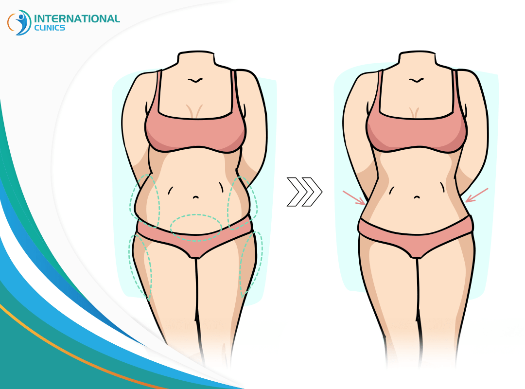 What To Expect 3 Weeks After Liposuction International Clinics What To Expect 3 Weeks After Liposuction International Clinics
